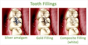 What’s the Difference Between Dental Fillings, PRR & Sealants?